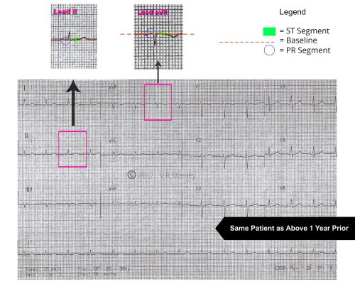 Stemi Mimic Series 3 Cases Of St Segment Elevation Differential