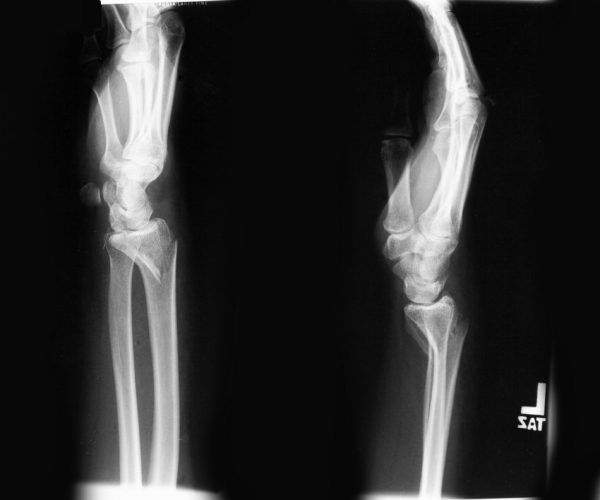 Smith's Fracture Copy ECGcourse.com