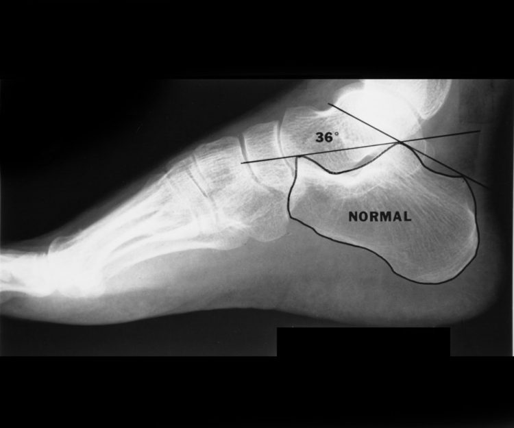 Normal Calcaneus and Boehler's Angle Copy ECGcourse.com