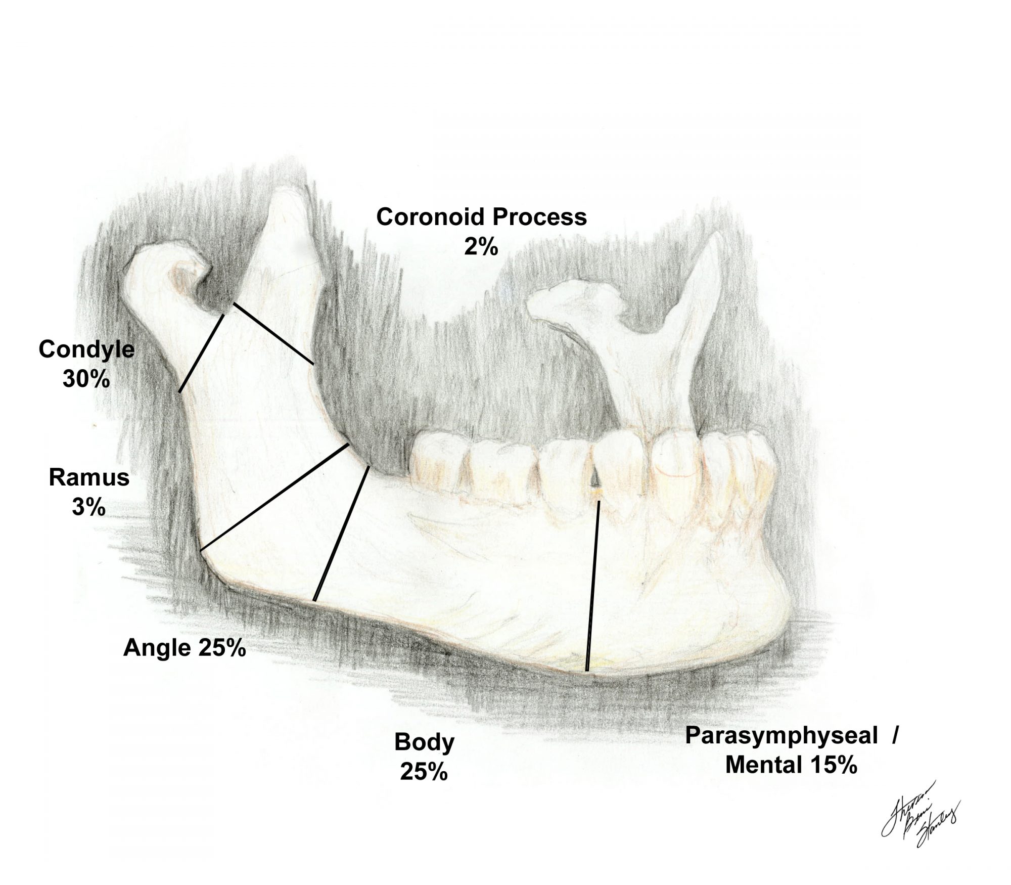 Most Common Sites of Mandible Fracture Copy ECGcourse.com