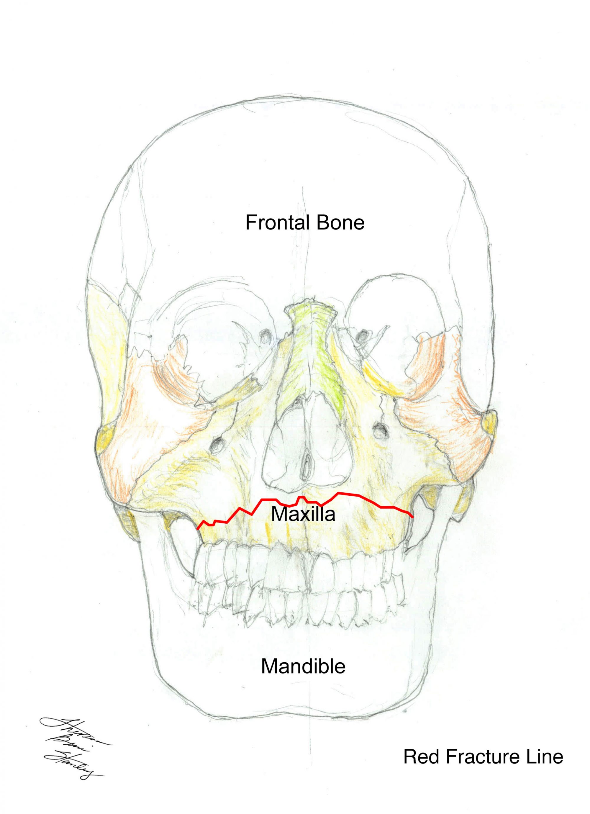 LeFort I Fracture...............Artist Sketch Copy ECGcourse.com