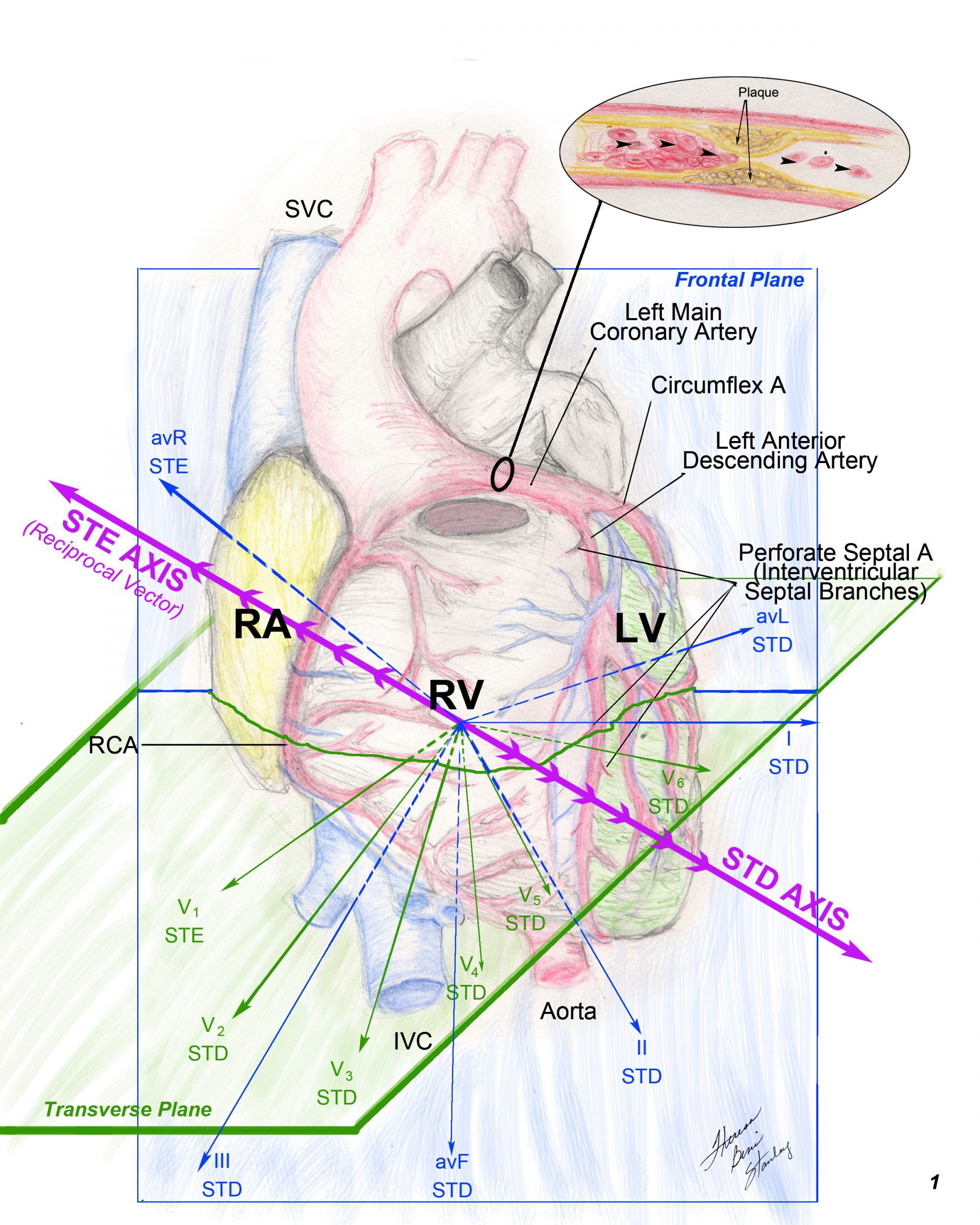 Left Main Artery Stenosis – How serious is a mild narrowing of the ...