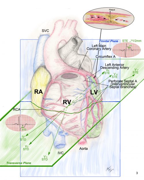 "R" is for qRs Analysis | Early R-Wave Transition & Abnormal R-wave ...