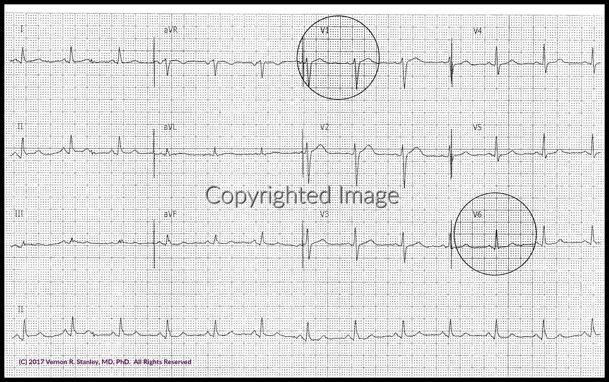 DSAE STEMI Review, Module 1: Normal 12-Lead Example ECGcourse.com