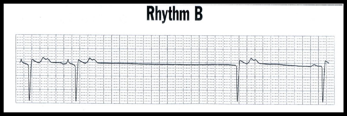 Reading an ECG Rhythm: 6 Common ECG Rhythm Examples ECGcourse.com