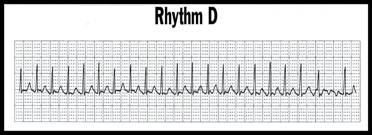Reading an ECG Rhythm: 6 Common ECG Rhythm Examples ECGcourse.com