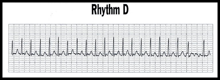 Reading an ECG Rhythm: 6 Common ECG Rhythm Examples ECGcourse.com