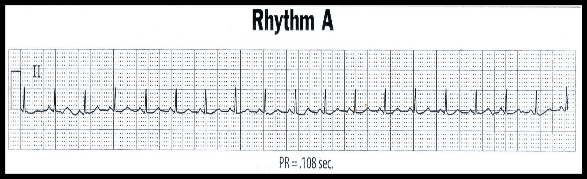 Reading an ECG Rhythm: 6 Common ECG Rhythm Examples ECGcourse.com