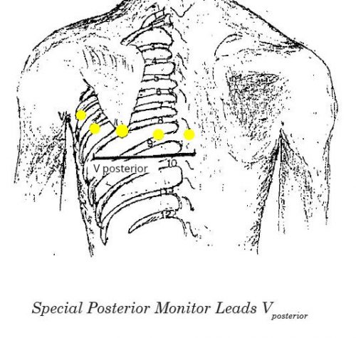 "R" is for qRs Analysis | Early R-Wave Transition & Abnormal R-wave ...