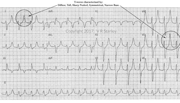 Differential Diagnosis for T-waves Changes on the 12-lead ECG ECGcourse.com