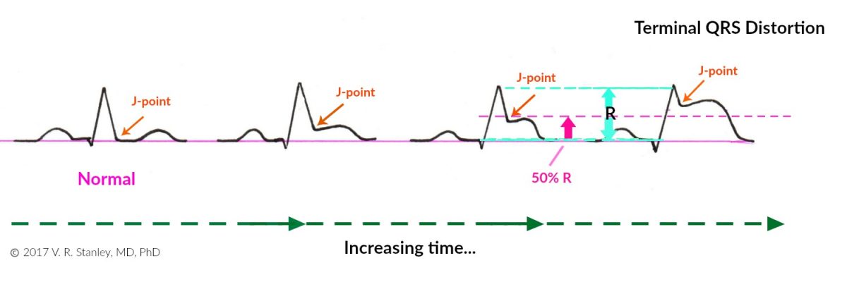 Terminal QRS Distortion on the 12-lead ECG ECGcourse.com