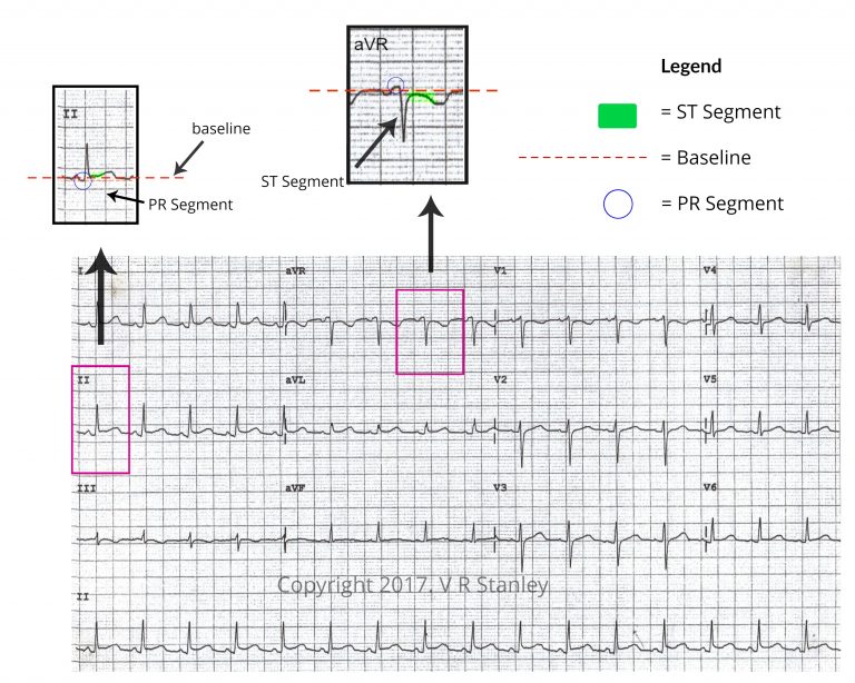 STEMI Mimic Series: 3 Cases of ST-Segment Elevation Differential ...