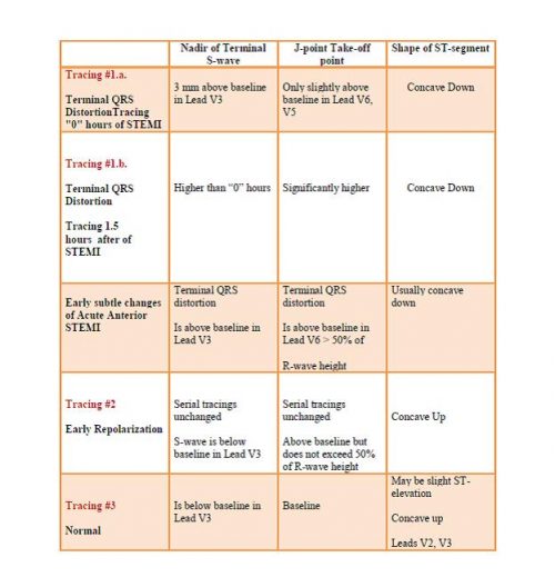 Terminal QRS Distortion on the 12-lead ECG ECGcourse.com