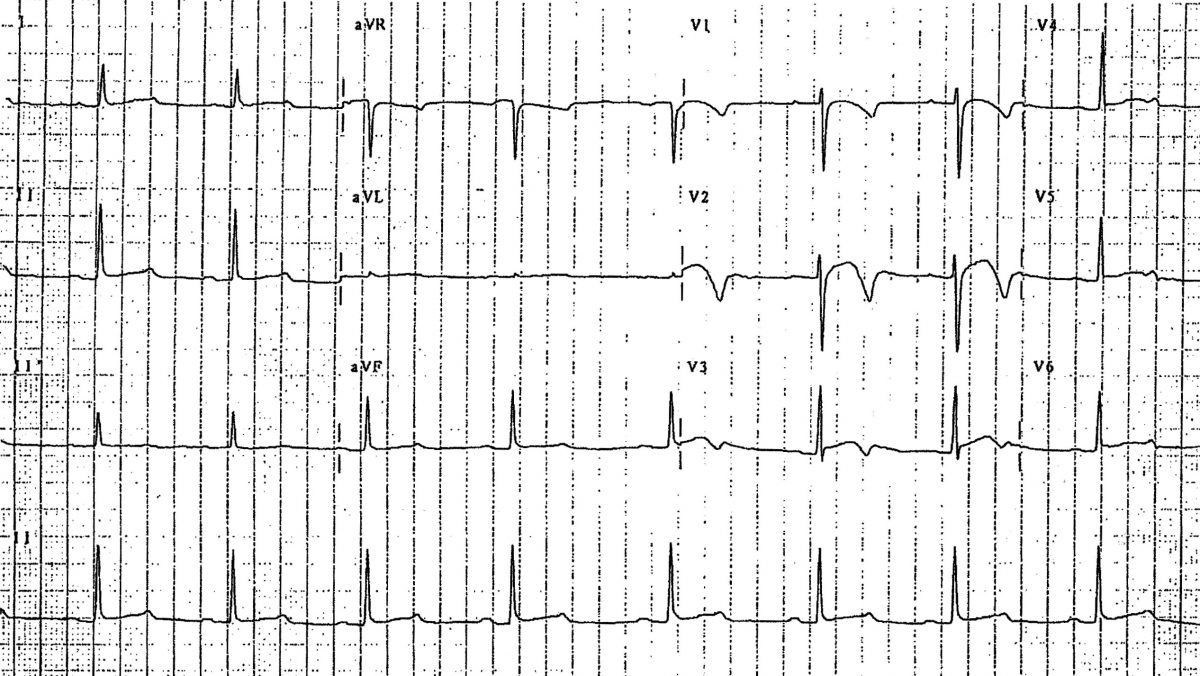 DSAE STEMI Review, Mod 2: Subarachnoid Hemorrhage (SAH) ECGcourse.com