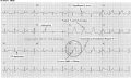 Terminal QRS Distortion on the 12-lead ECG ECGcourse.com