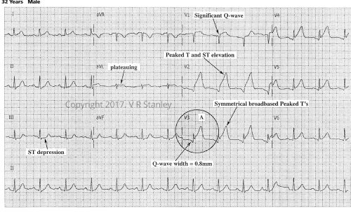 2 Cases ST Elevation: Benign Normal Variant vs Acute STEMI ECGcourse.com