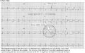 2 Cases ST Elevation: Benign Normal Variant vs Acute STEMI ECGcourse.com