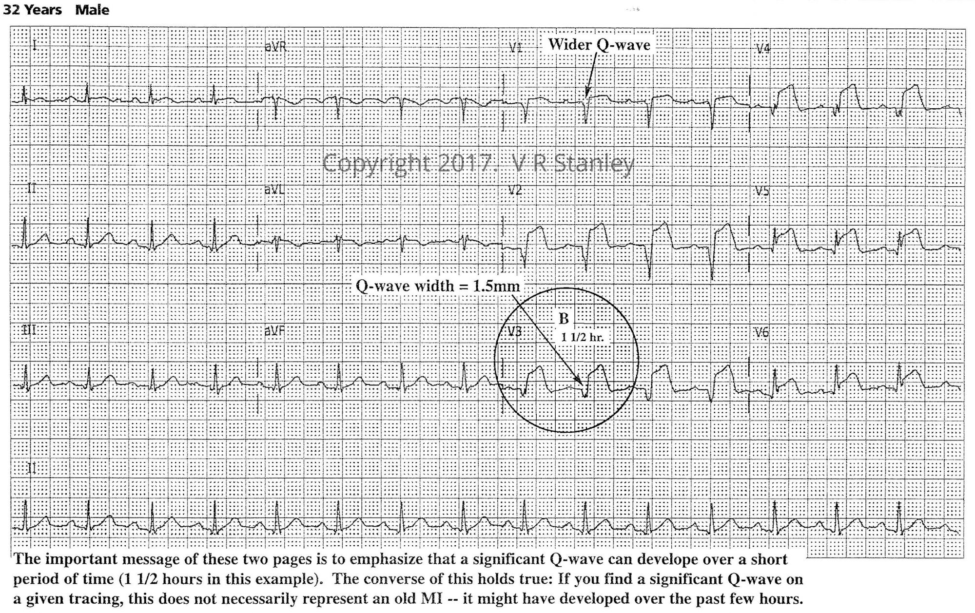 Stemi Review Acute Al Stemi Ecg 2