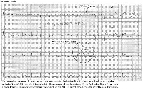DSAE STEMI Review, Mod 2: Terminal QRS Distortion & the ST Segment ...