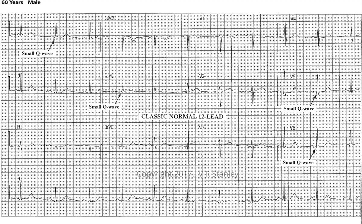 Terminal QRS Distortion on the 12-lead ECG ECGcourse.com