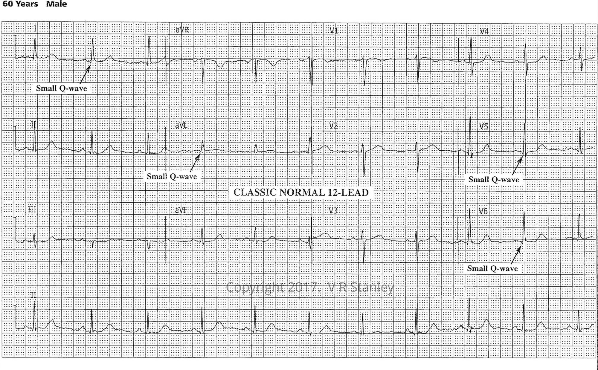 Terminal QRS Distortion on the 12-lead ECG ECGcourse.com