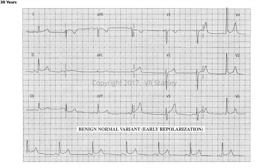 2 Cases ST Elevation: Benign Normal Variant vs Acute STEMI ECGcourse.com