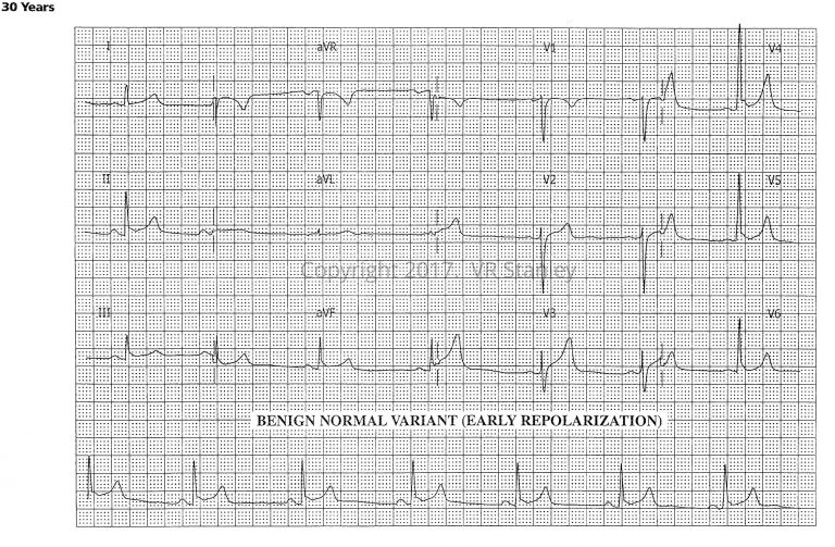 2 Cases ST Elevation: Benign Normal Variant vs Acute STEMI ECGcourse.com