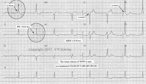 Wolff Parkinson White Syndrome | Short PR Interval - ECGcourse.com