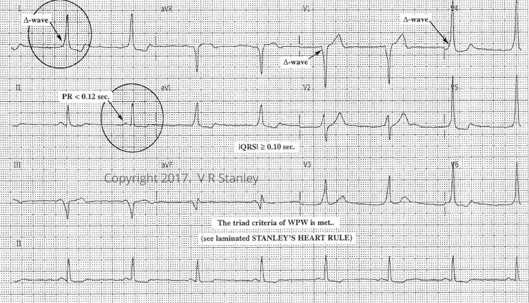 Wolff Parkinson White Syndrome and the Short PR Interval on ECG ...