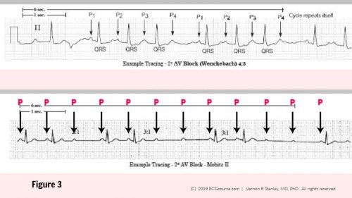 ECG Rhythms: Is this Rhythm Second Degree AV Block 2:1 Mobitz 1 (I) or ...