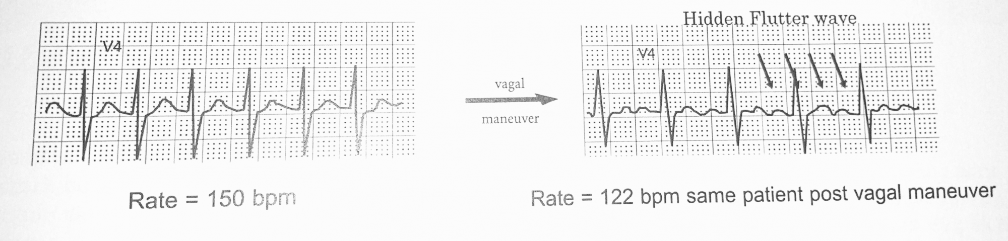 Special Case of Ventricular Rate = 150 bpm ECGcourse.com