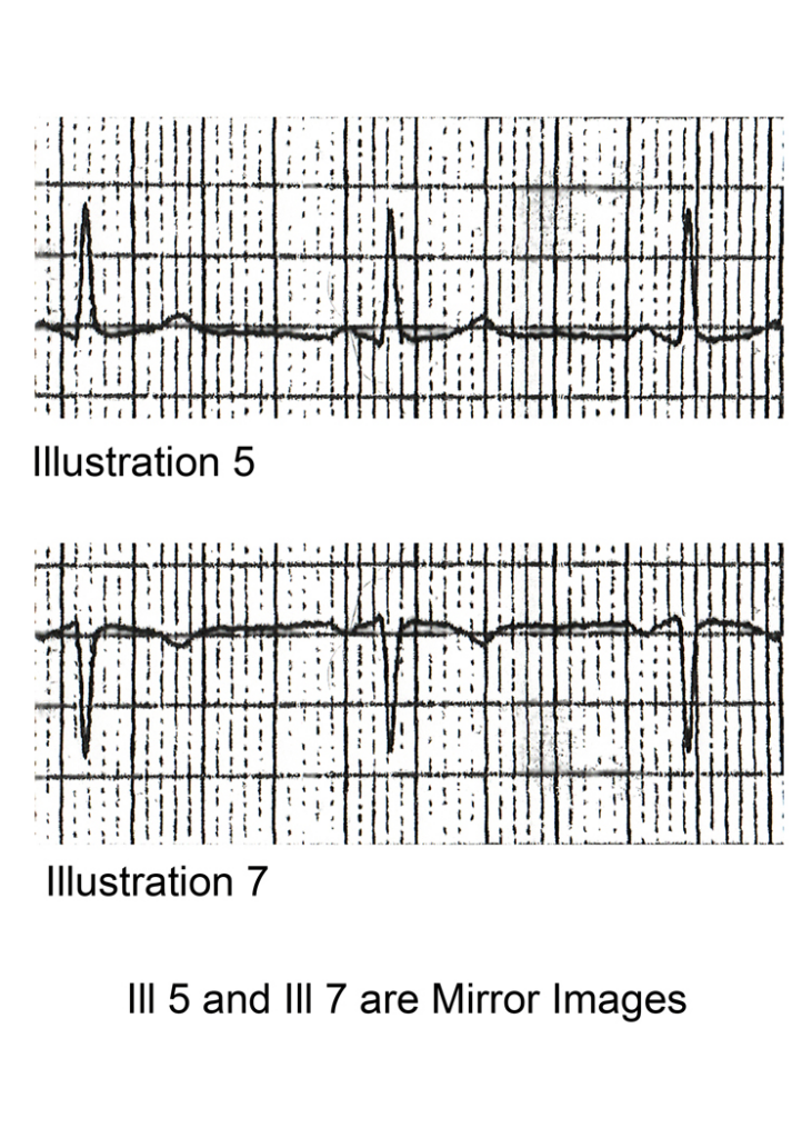 12-lead ECG: Changes of Reciprocity & Einthoven's Triangle ECGcourse.com