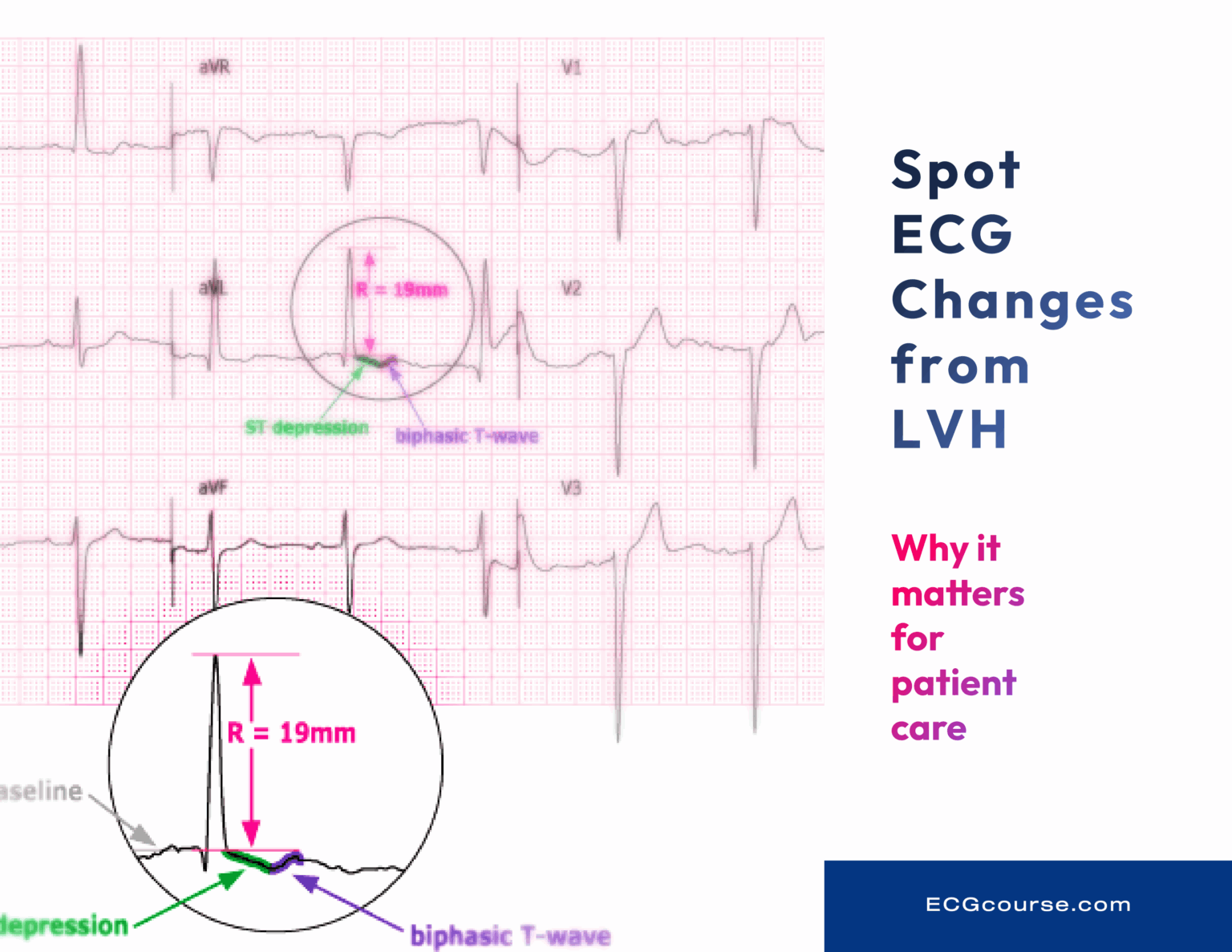 3 Things You Need to Know about ECG Changes from LVH ECGcourse.com 3 ...